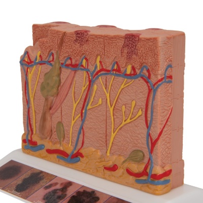 3B Scientific Magnified Skin Cancer Model | Health and Care